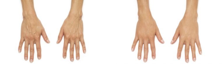 RADIESSE: LIFT WITH LONG-TERM COLLAGEN STIMULATION